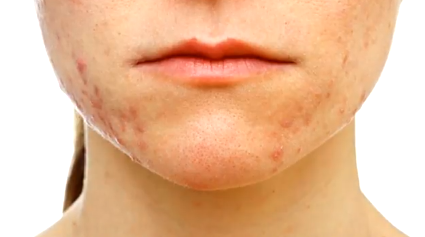Back-to-school acne is a thing; what you can do about it | khou.com
